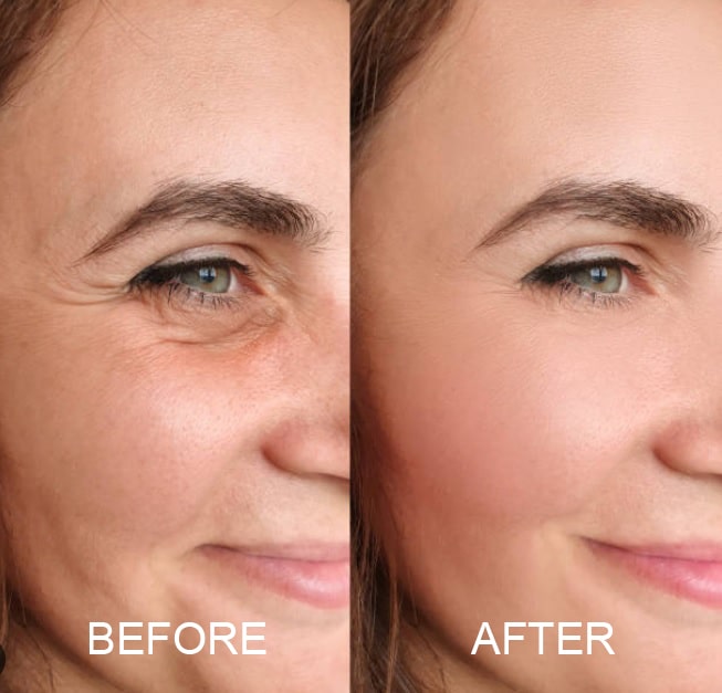 A Guide to Injections: 7 Things You Need to Know Before Getting Botox ...